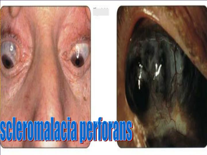 PPT - EPISCLERITIS/ SCLERITIS PowerPoint Presentation - ID:6415513