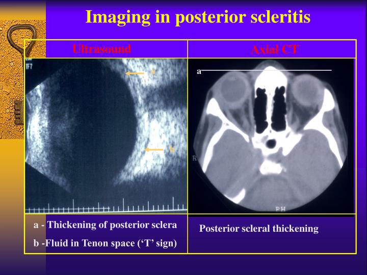 PPT - EPISCLERITIS/ SCLERITIS PowerPoint Presentation - ID:6415513