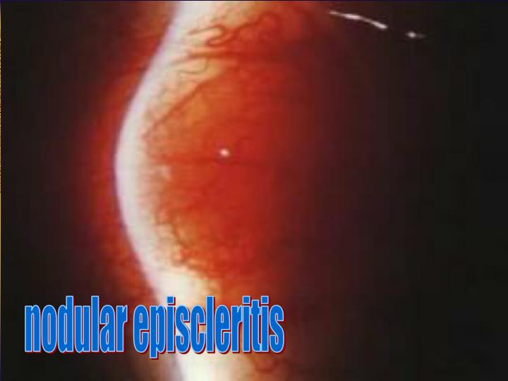 PPT - EPISCLERITIS/ SCLERITIS PowerPoint Presentation - ID:6415513