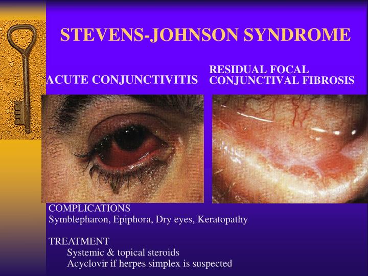 PPT - EPISCLERITIS/ SCLERITIS PowerPoint Presentation - ID:6415513