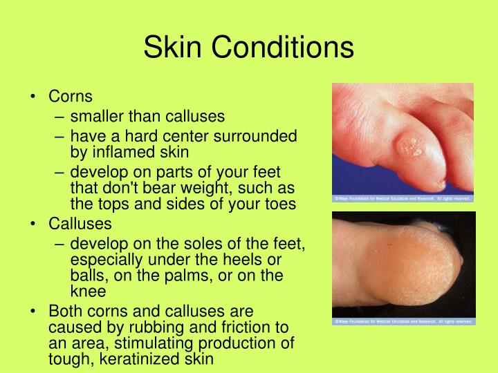Gross Skin Conditions