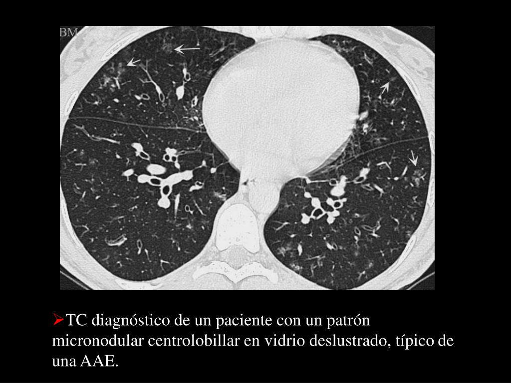 PPT - Pacientes con patrón micronodulillar centrolobillar PowerPoint ...