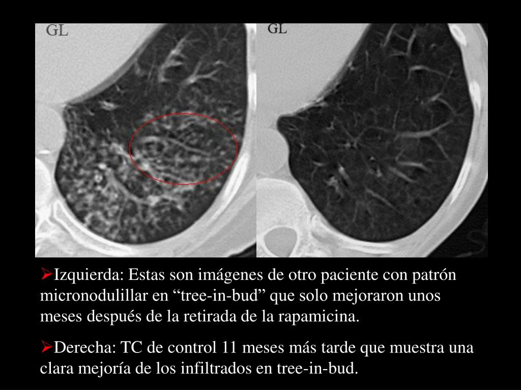 PPT - Pacientes con patrón micronodulillar centrolobillar PowerPoint ...