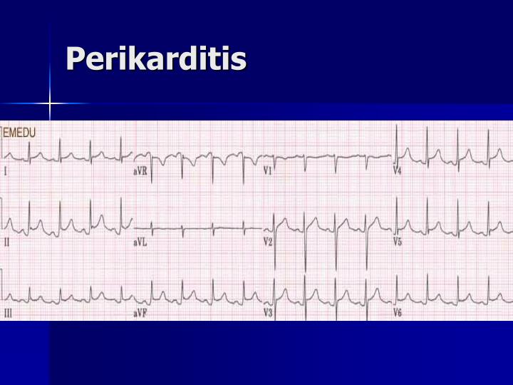 PPT - EKG undervisning PowerPoint Presentation - ID:6494617