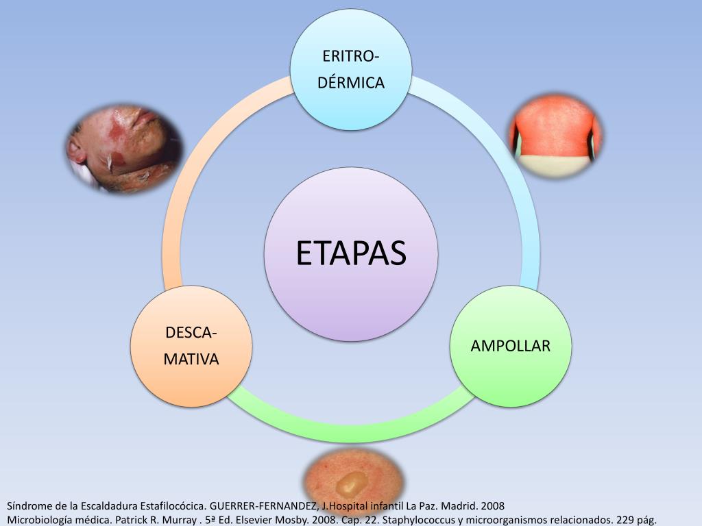 PPT - Síndrome de la Piel Escaldada Estafilocócica PowerPoint ...