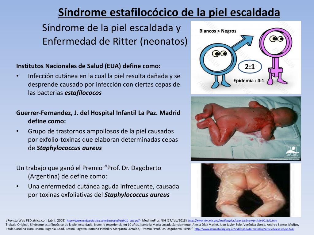PPT - Síndrome de la Piel Escaldada Estafilocócica PowerPoint ...