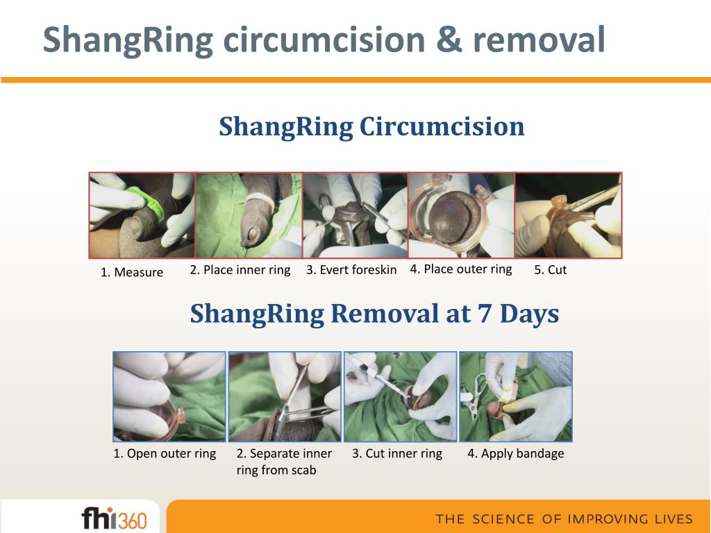 PPT - Performance of the ShangRing for Medical Male Circumcision in ...