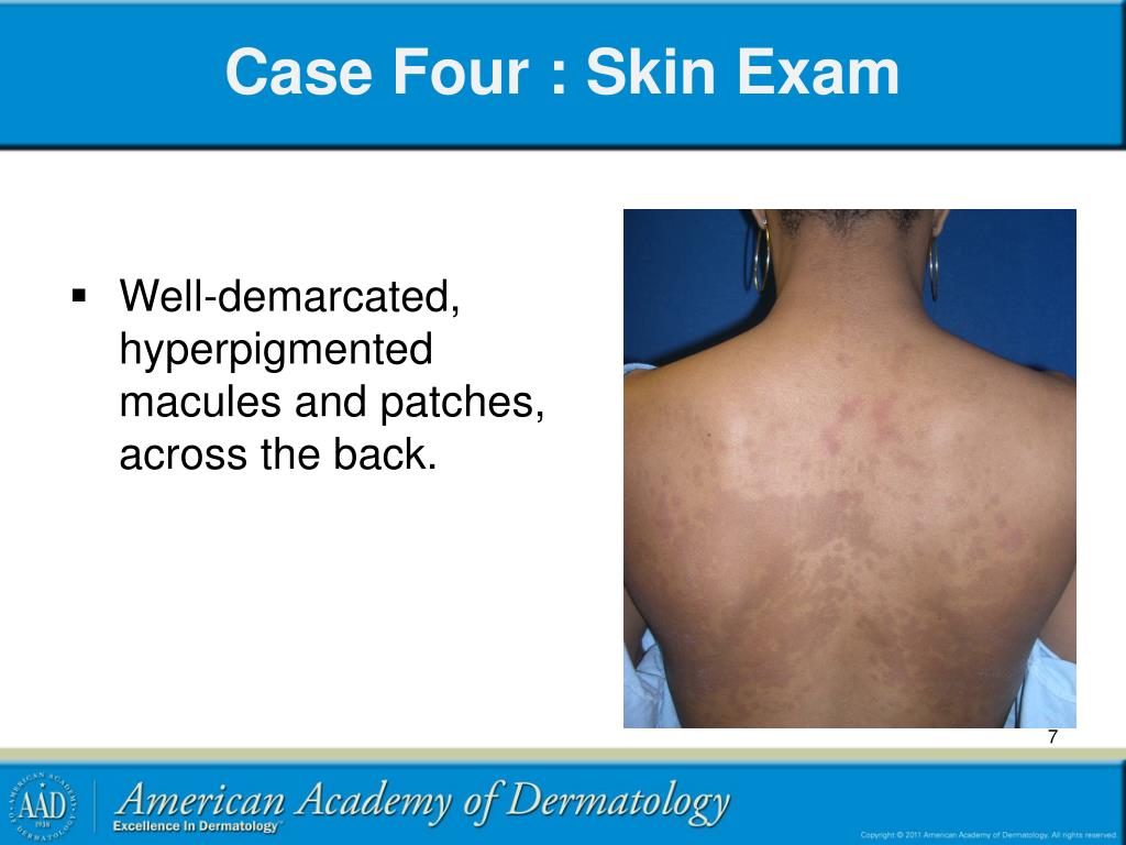 PPT - Adult Cutaneous Fungal Infections 2: Yeasts PowerPoint ...