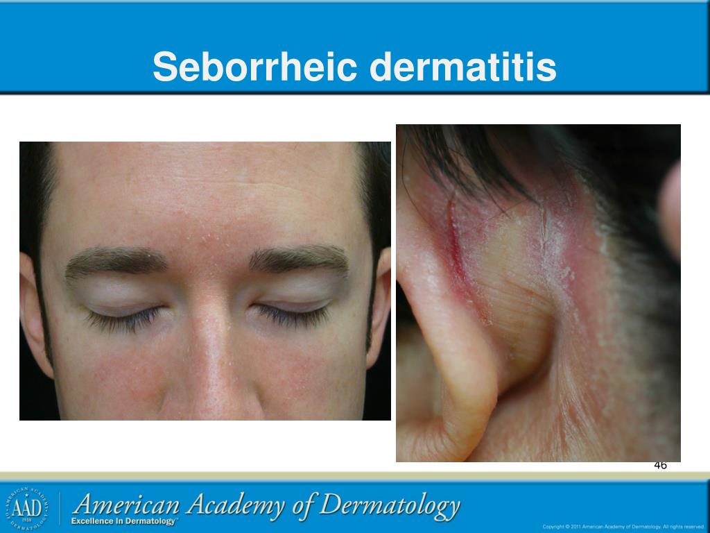 PPT - Adult Cutaneous Fungal Infections 2: Yeasts PowerPoint ...