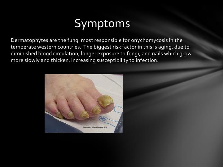 PPT - ONYCHOMYCOSIS PowerPoint Presentation - ID:6516151