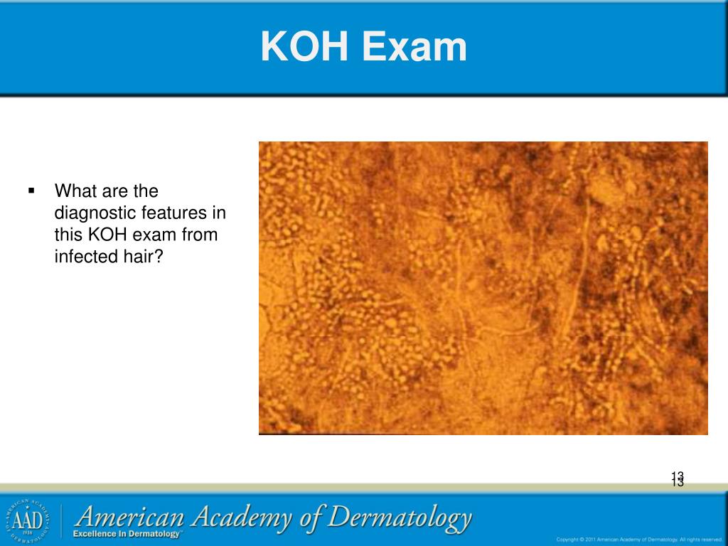 PPT - Pediatric Cutaneous Fungal Infections PowerPoint Presentation ...
