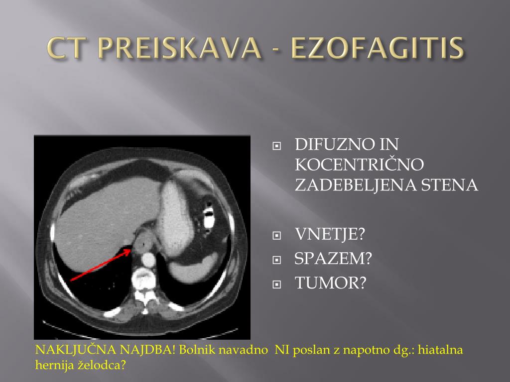 PPT - GERB gastro-ezofagealna refluksna bolezen PowerPoint Presentation ...