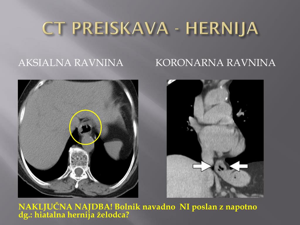 PPT - GERB gastro-ezofagealna refluksna bolezen PowerPoint Presentation ...