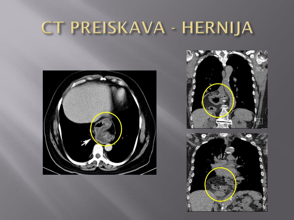 PPT - GERB gastro-ezofagealna refluksna bolezen PowerPoint Presentation ...