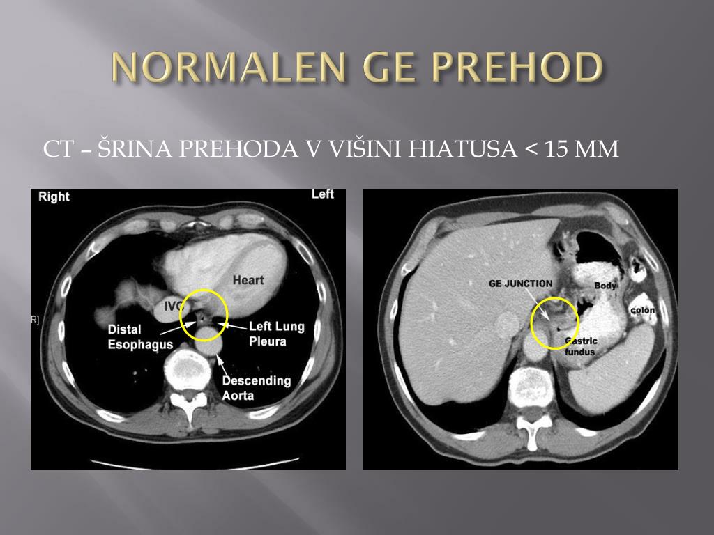 PPT - GERB gastro-ezofagealna refluksna bolezen PowerPoint Presentation ...