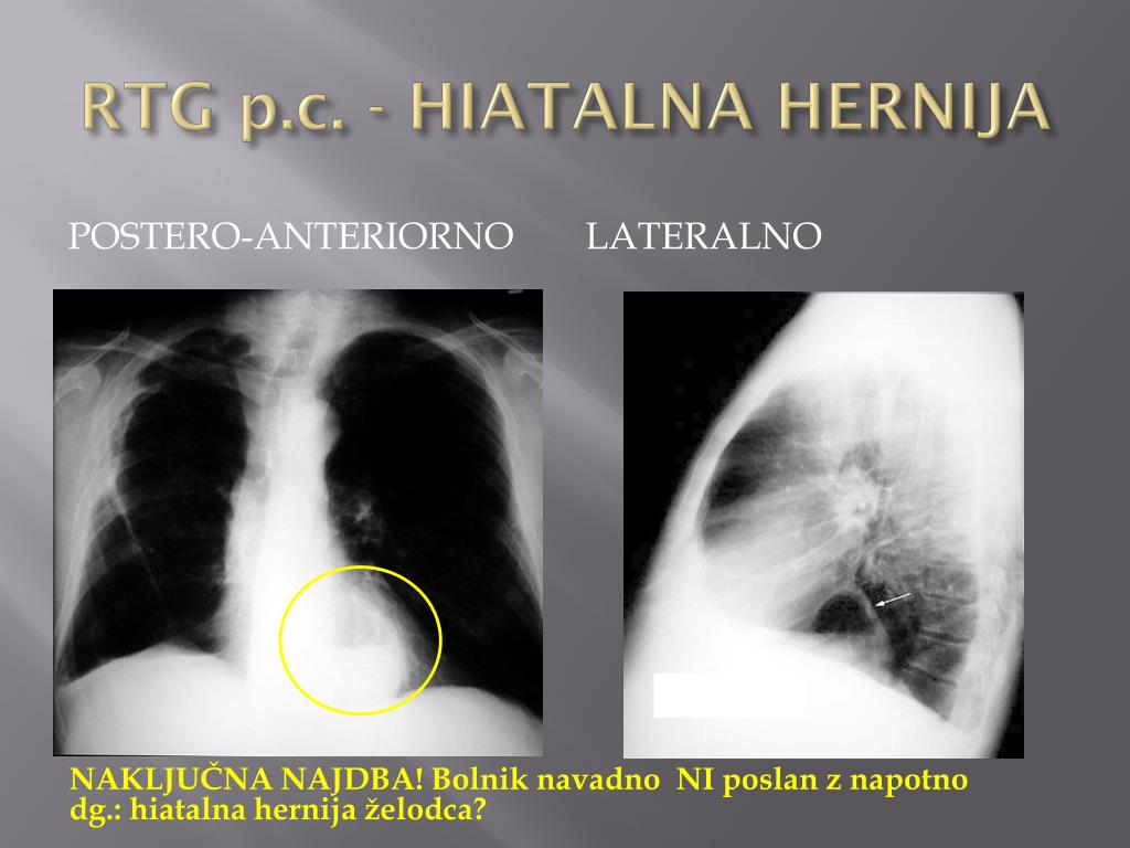 PPT - GERB gastro-ezofagealna refluksna bolezen PowerPoint Presentation ...