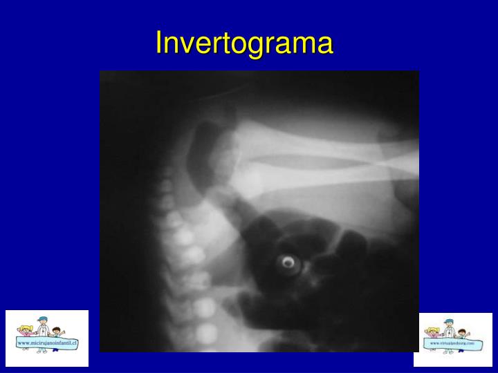 PPT - Malformaciones Ano Rectales PowerPoint Presentation - ID:6527797