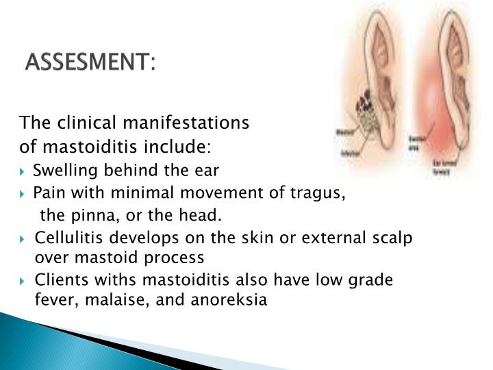 PPT - MASTOIDITIS PowerPoint Presentation - ID:6530683