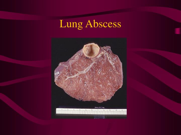 PPT - TB, Lung Abscess, and Cystic Fibrosis PowerPoint Presentation ...