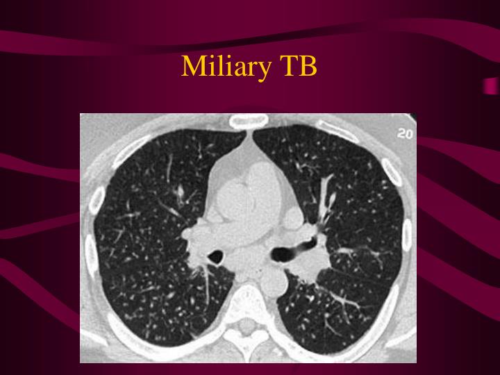 PPT - TB, Lung Abscess, and Cystic Fibrosis PowerPoint Presentation ...