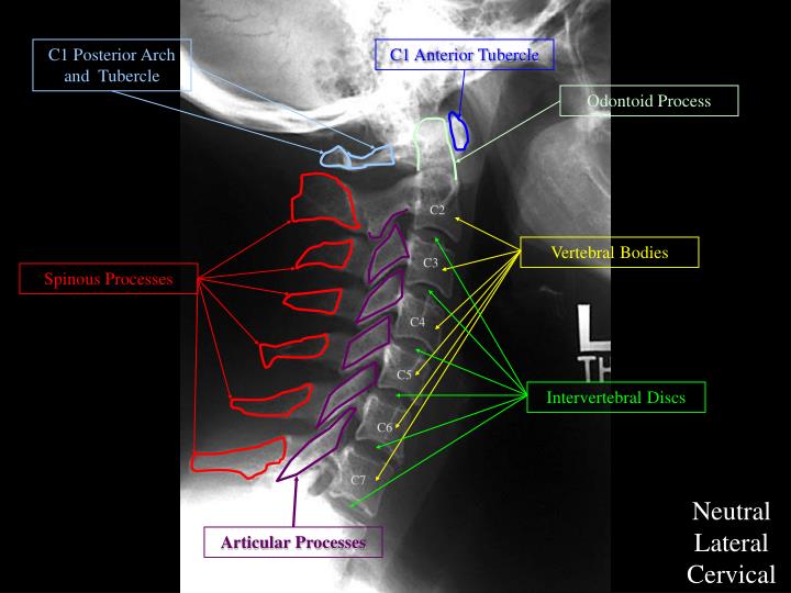 PPT - Normal Radiographic Spinal Anatomy PowerPoint Presentation - ID ...