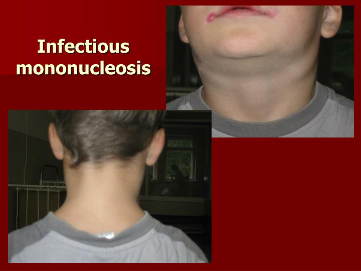 PPT - Infectious diseases with tonsillitis. Diphtheria PowerPoint ...