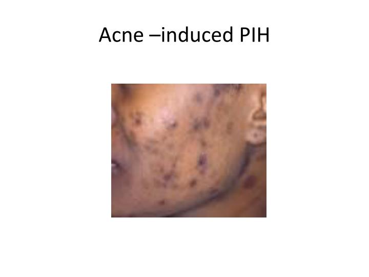 PPT - Dermatology in Individuals with SKIN OF COLOR PowerPoint ...