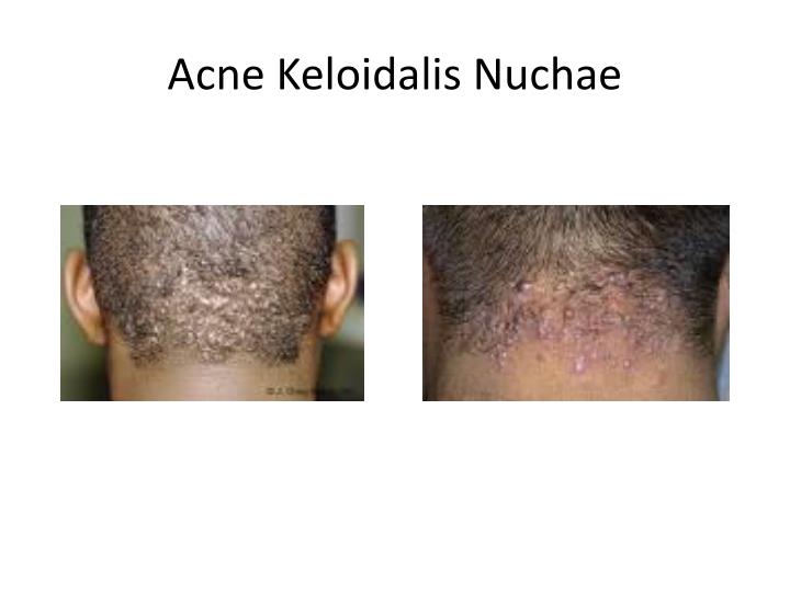 PPT - Dermatology in Individuals with SKIN OF COLOR PowerPoint ...