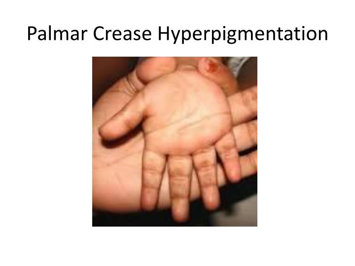PPT - Dermatology in Individuals with SKIN OF COLOR PowerPoint ...