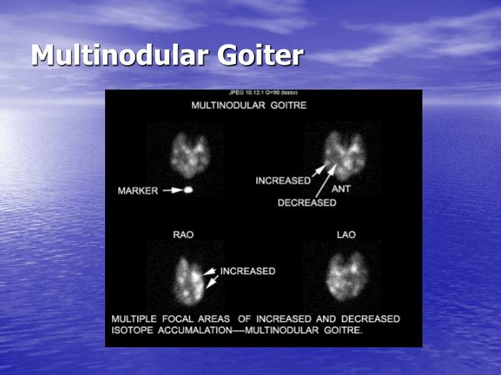 PPT - NUCLEAR MEDICINE IN DIAGNOSIS AND TREATMENT OF Thyroid DISEASES ...