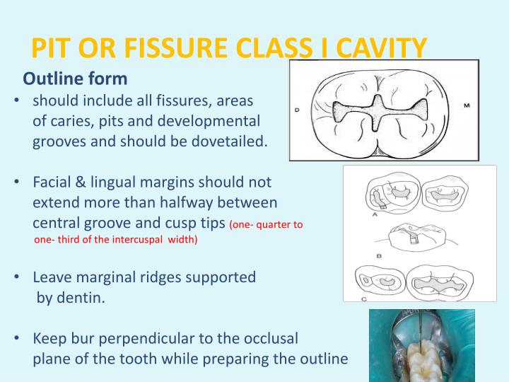 PPT - Cavity preparation for Amalgam, class I PowerPoint Presentation ...