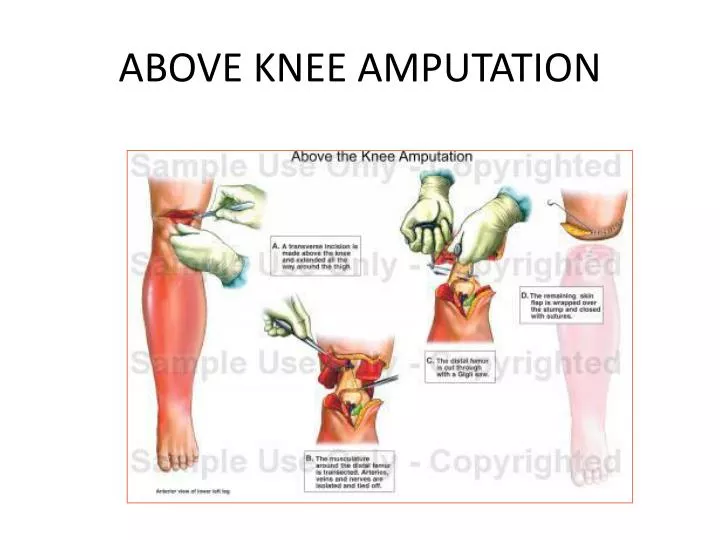 PPT - ABOVE KNEE AMPUTATION PowerPoint Presentation, free download - ID:6565721