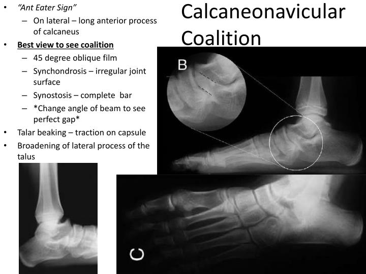 PPT - Tarsal Coalition PowerPoint Presentation - ID:6578156