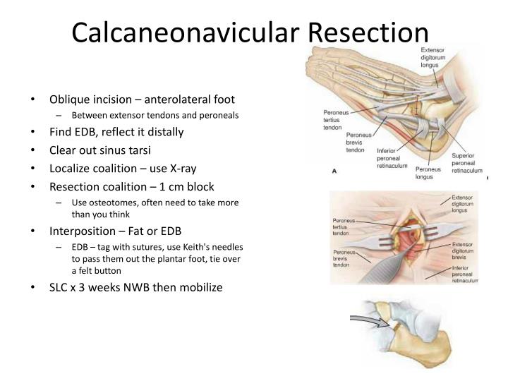 PPT - Tarsal Coalition PowerPoint Presentation - ID:6578156
