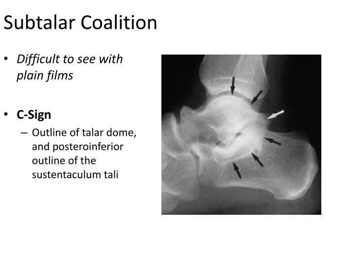 PPT - Tarsal Coalition PowerPoint Presentation - ID:6578156