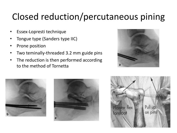 PPT - Calcaneal Fractures PowerPoint Presentation - ID:6578166