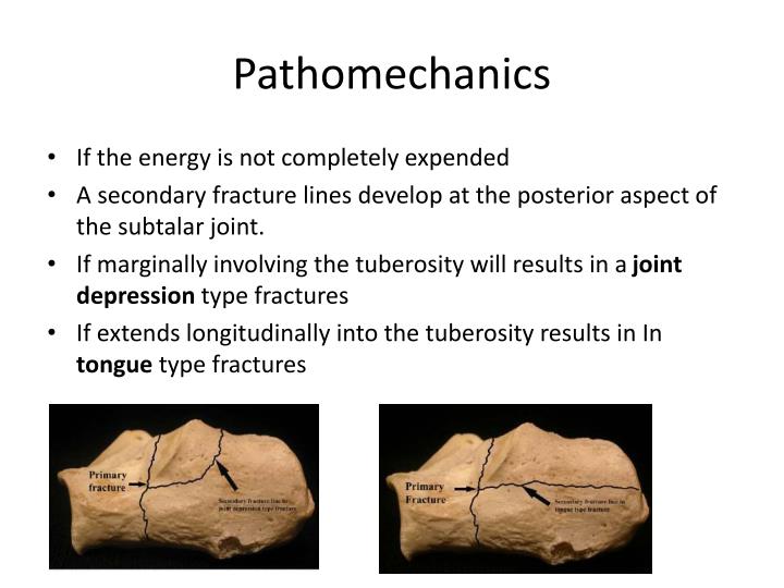 PPT - Calcaneal Fractures PowerPoint Presentation - ID:6578166