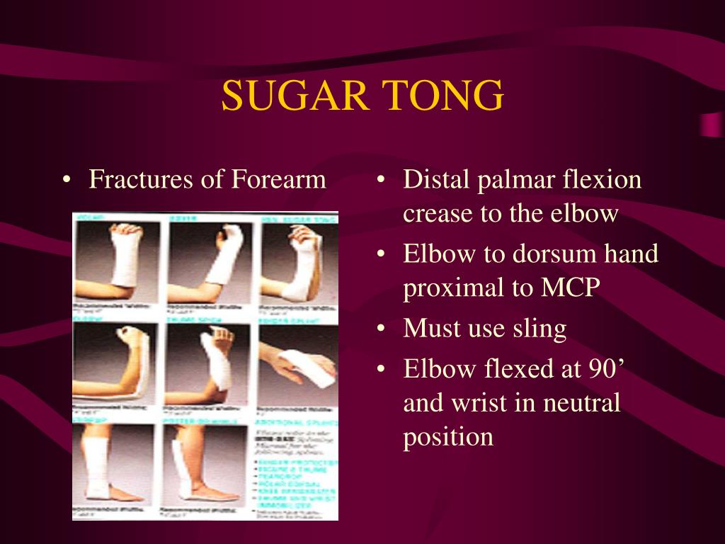 Sugar Tong Splint Procedure Code At Della Annis Blog