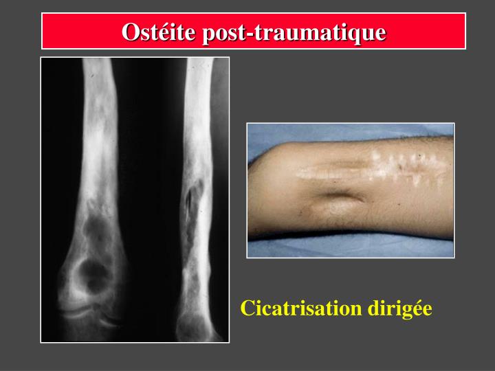 PPT - 3/ OSTÉOMYÉLITE CHRONIQUE PowerPoint Presentation - ID:6582042