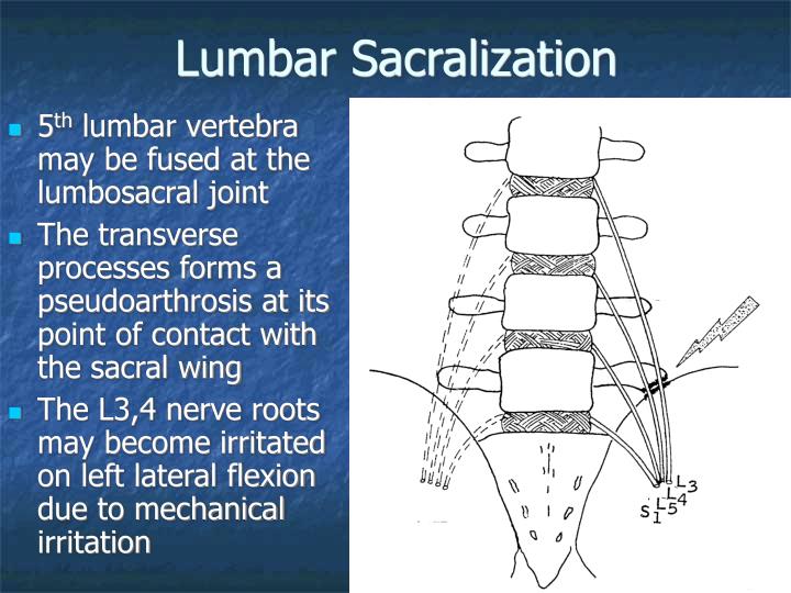 PPT - Lumbar Spine PowerPoint Presentation - ID:6582772