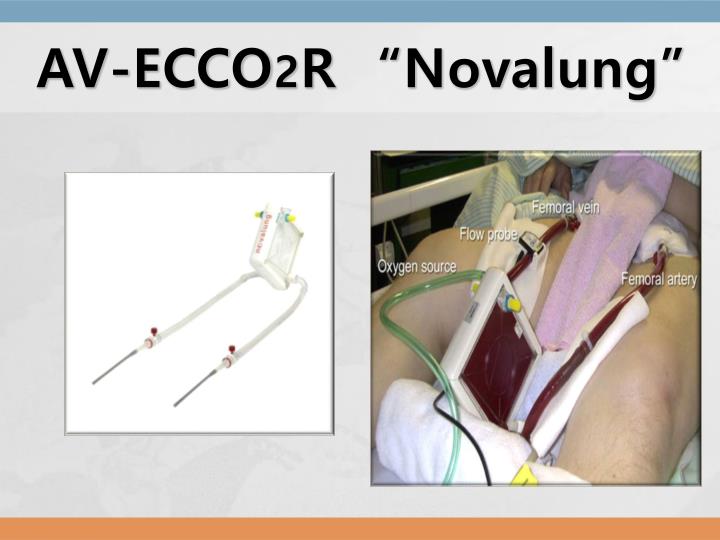 PPT - ECMO (U nderstanding and Management ) PowerPoint Presentation ...