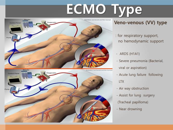 PPT - ECMO (U nderstanding and Management ) PowerPoint Presentation - ID:6589326