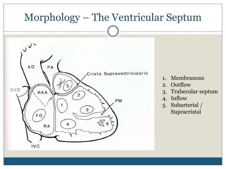 PPT - Ventricular Septal Defects PowerPoint Presentation - ID:6592163