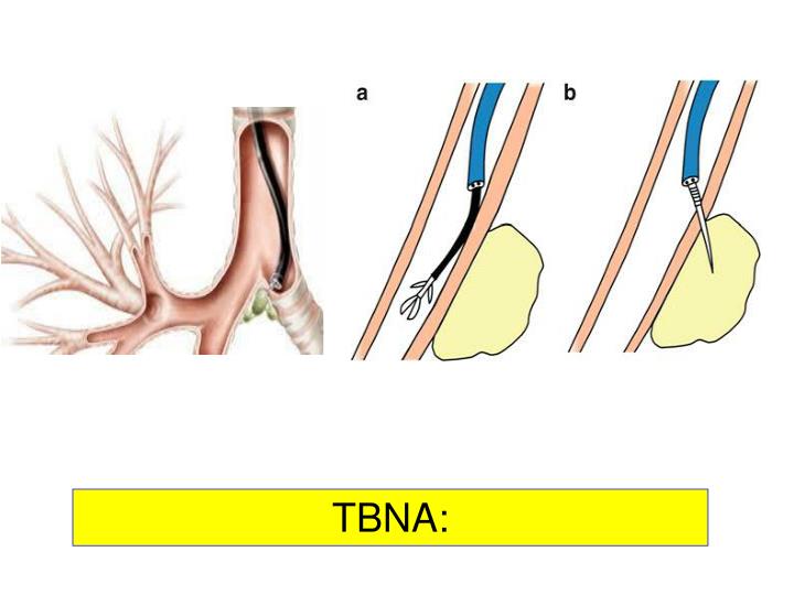 PPT - TBLB in DX of peripheral and diffuse lung cancer PowerPoint ...