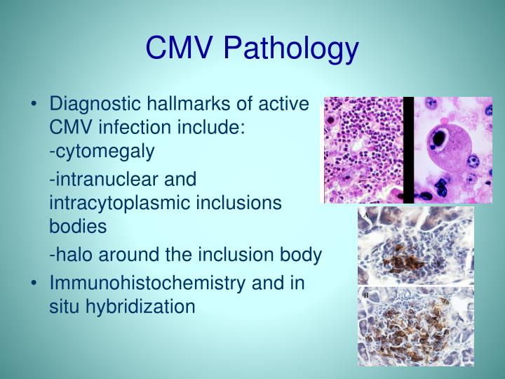 PPT - Cytomegalovirus Infection in Renal Transplantation PowerPoint ...