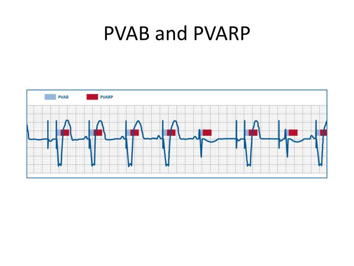 PPT - BASICS OF PACEMAKER PowerPoint Presentation - ID:6593572