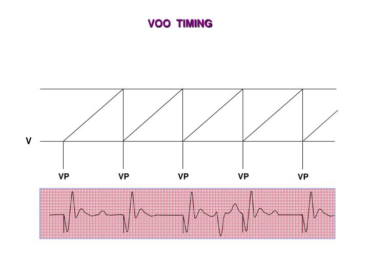 PPT - BASICS OF PACEMAKER PowerPoint Presentation - ID:6593572