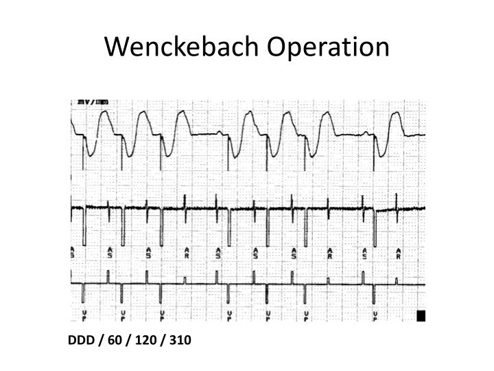 PPT - BASICS OF PACEMAKER PowerPoint Presentation - ID:6593572