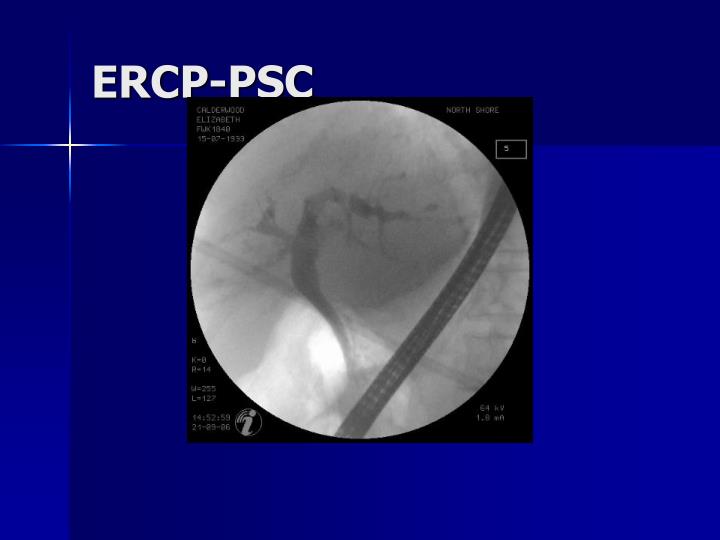 PPT - Primary Sclerosing Cholangitis and Primary Biliary Cirrhosis ...