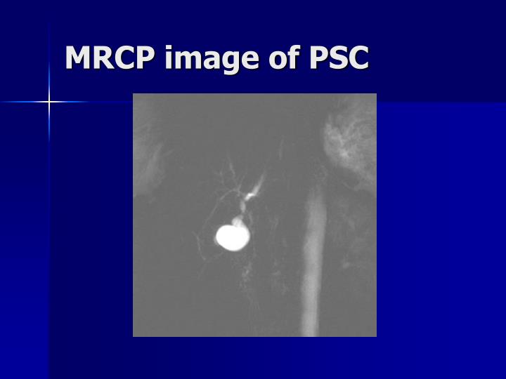 PPT - Primary Sclerosing Cholangitis and Primary Biliary Cirrhosis ...